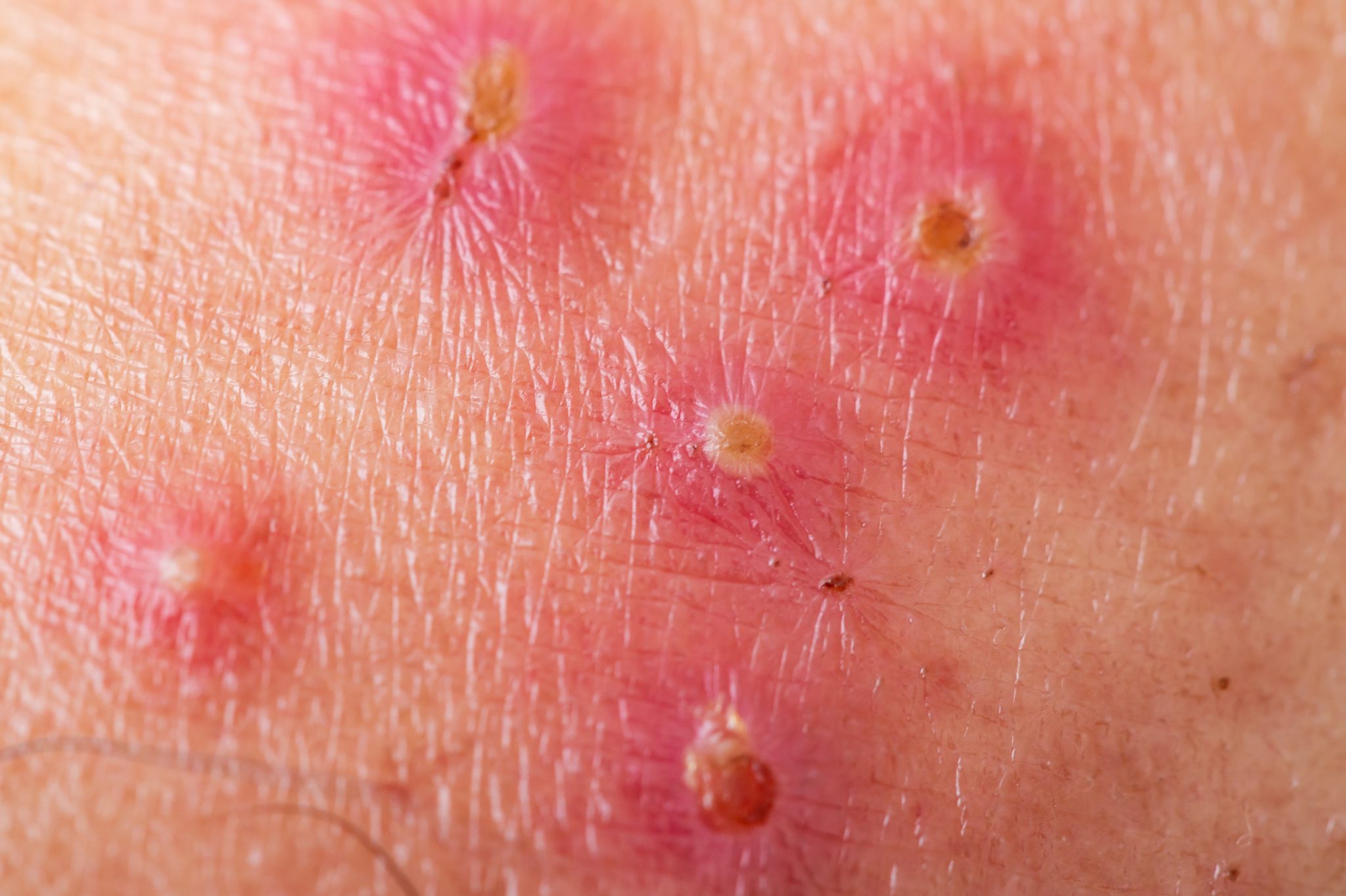 Jak działa azytromycyna? - Poradnik Gemini